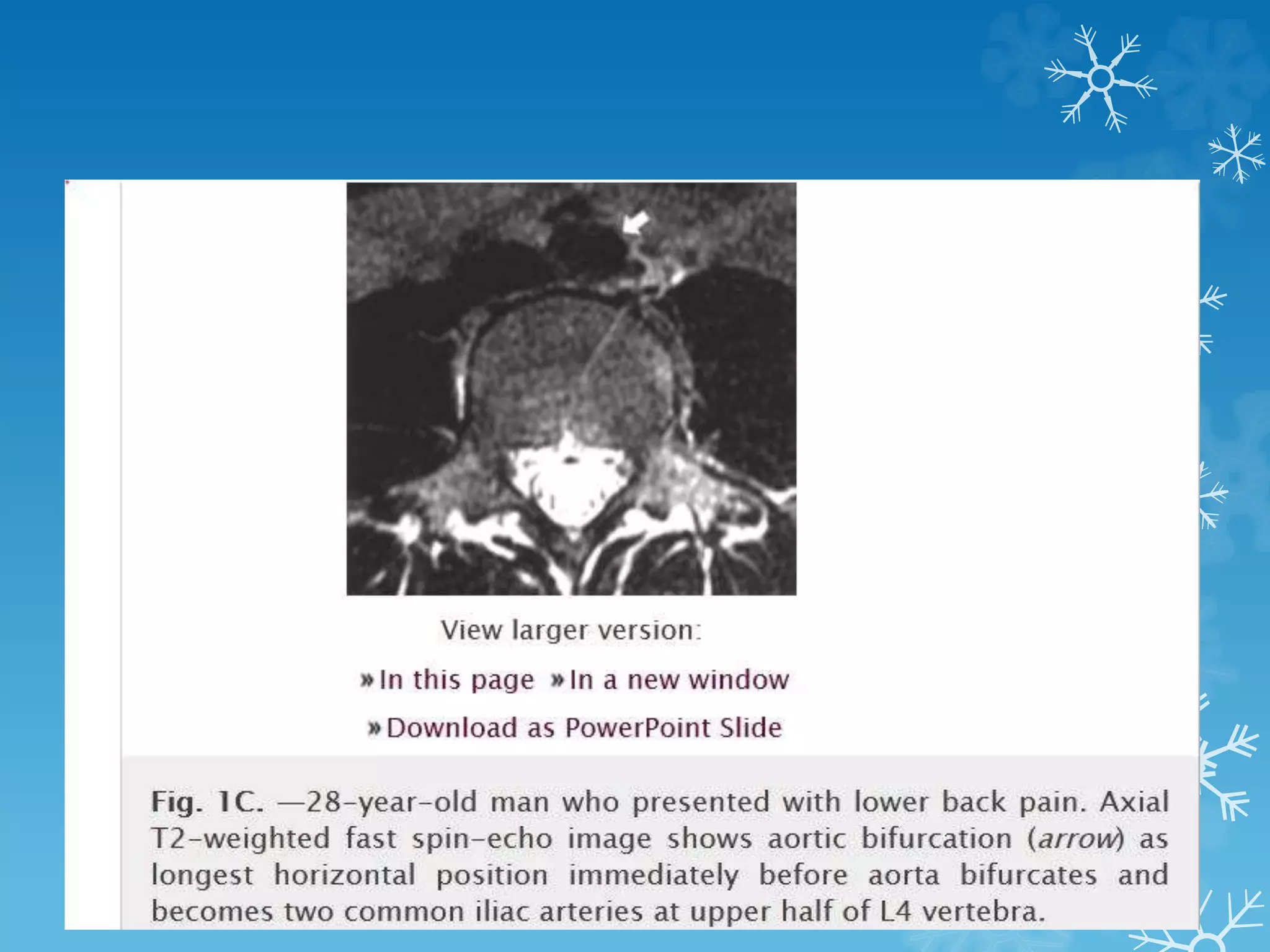 Transitional vertebrae radiology | PPTX