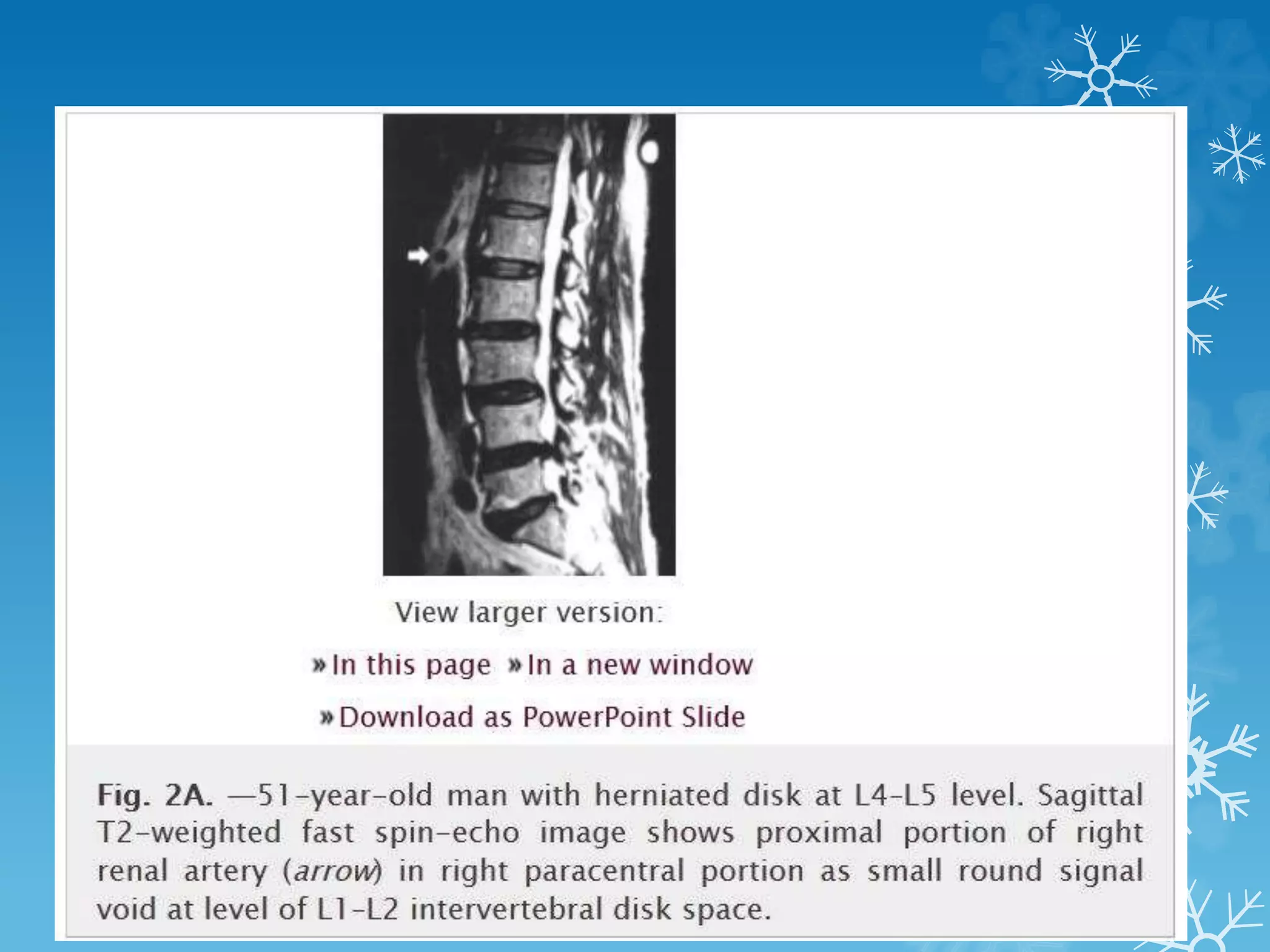 Transitional vertebrae radiology | PPTX