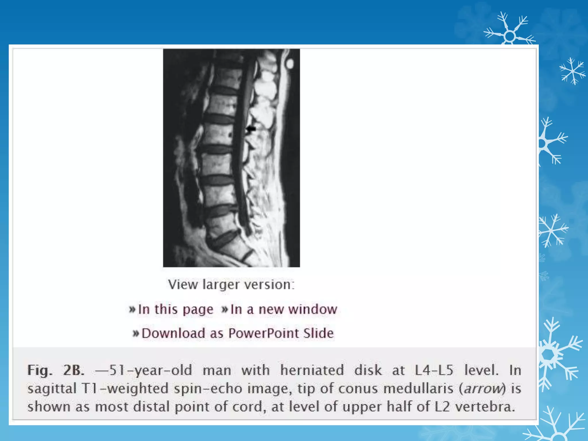 Transitional vertebrae radiology | PPTX