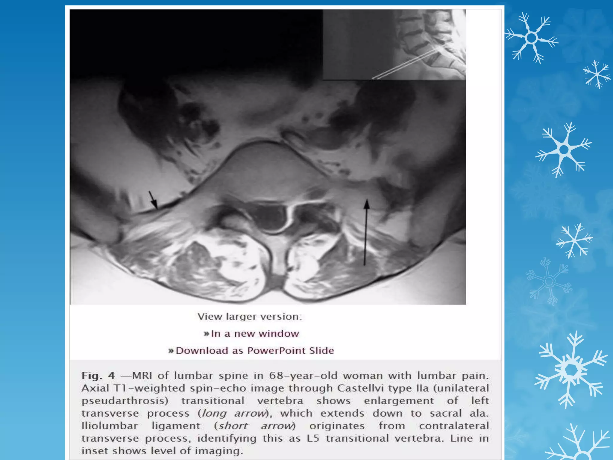 Transitional vertebrae radiology | PPTX