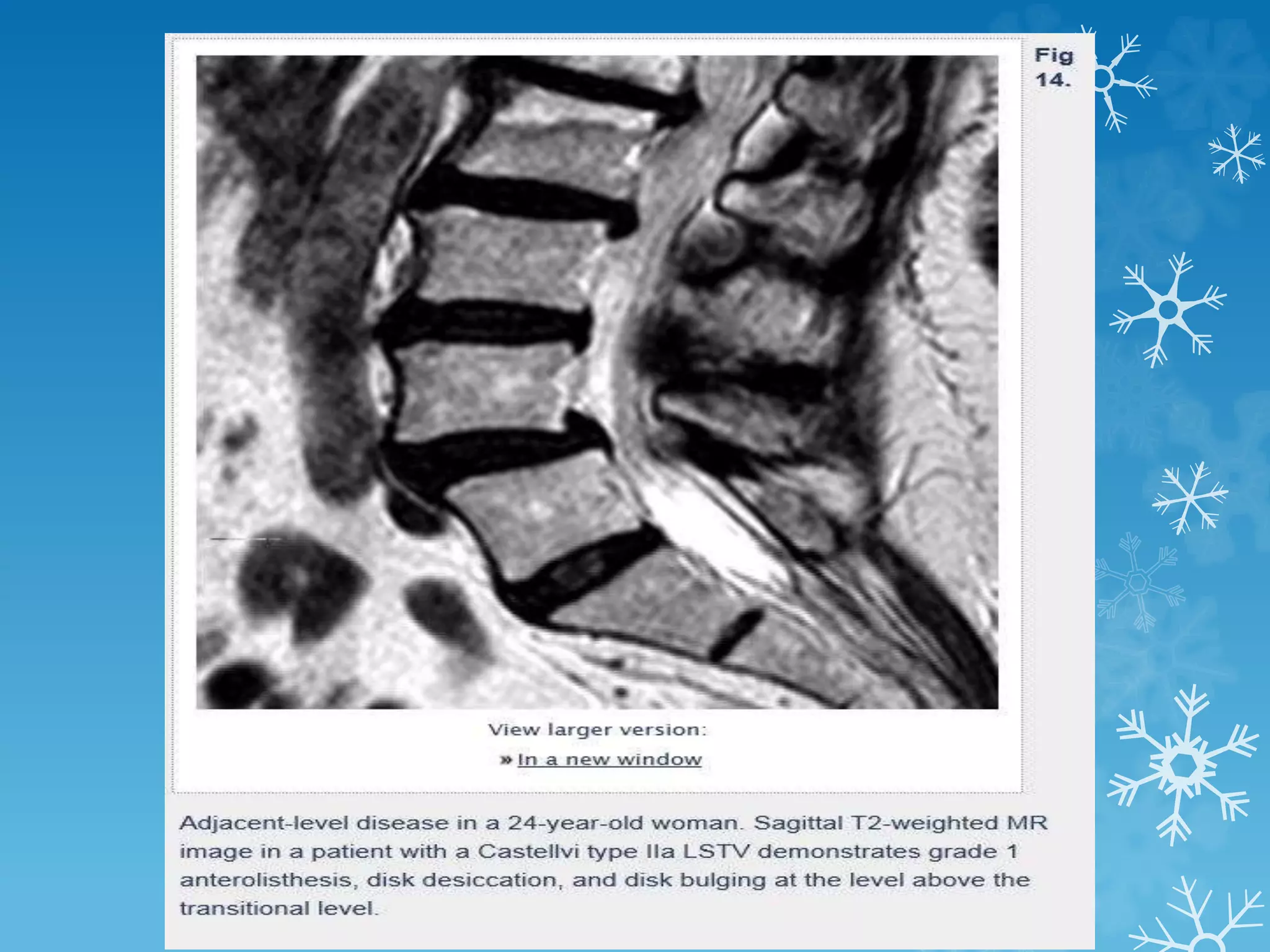 Transitional vertebrae radiology | PPTX