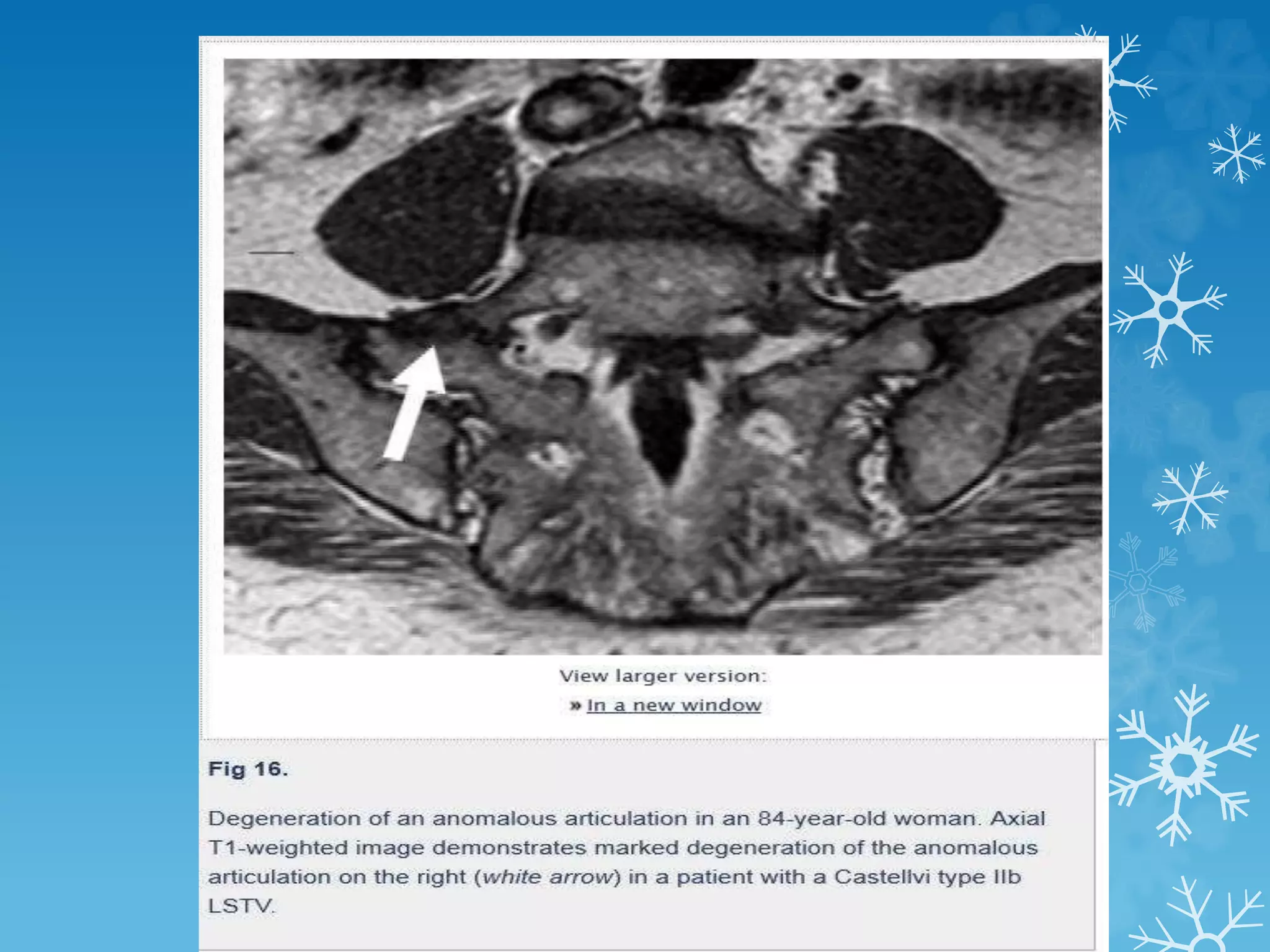 Transitional vertebrae radiology | PPTX