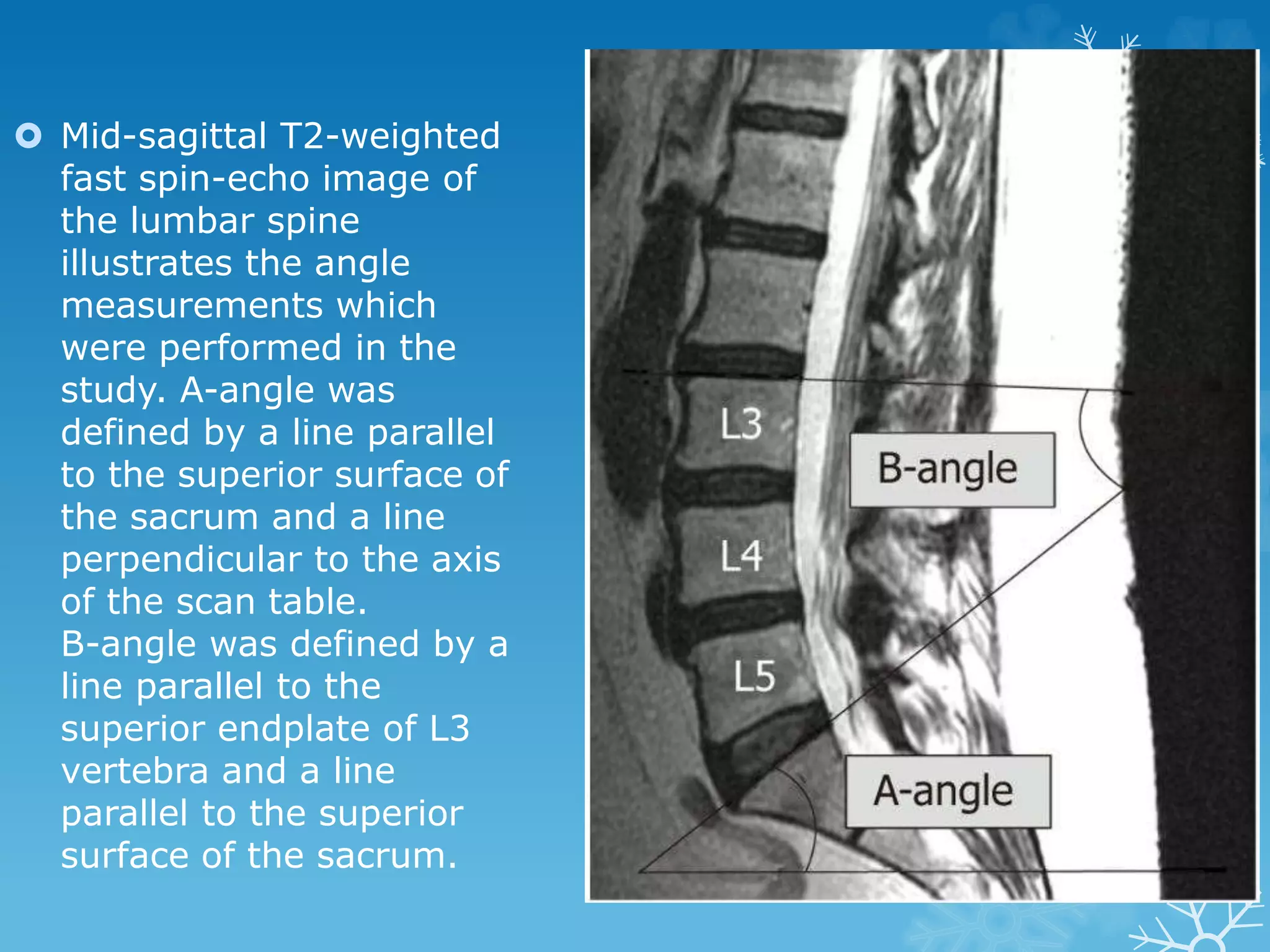 Transitional vertebrae radiology | PPTX