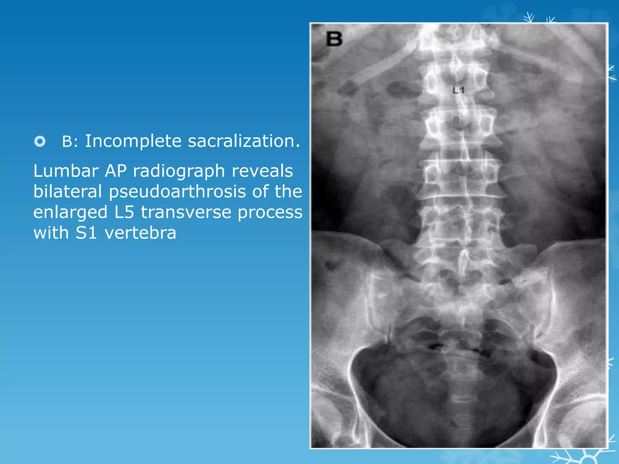 Transitional vertebrae radiology | PPTX
