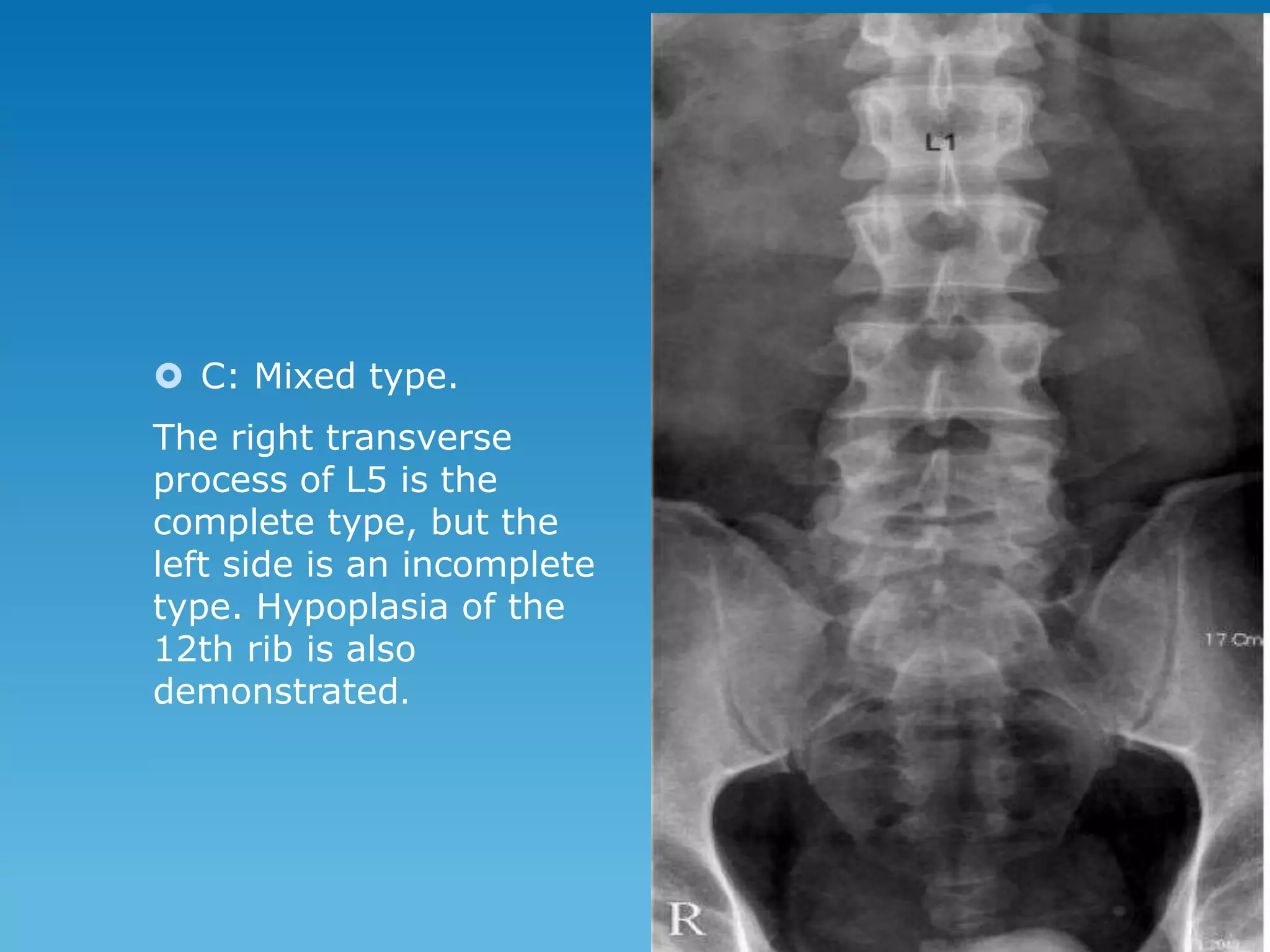 Transitional vertebrae radiology | PPTX