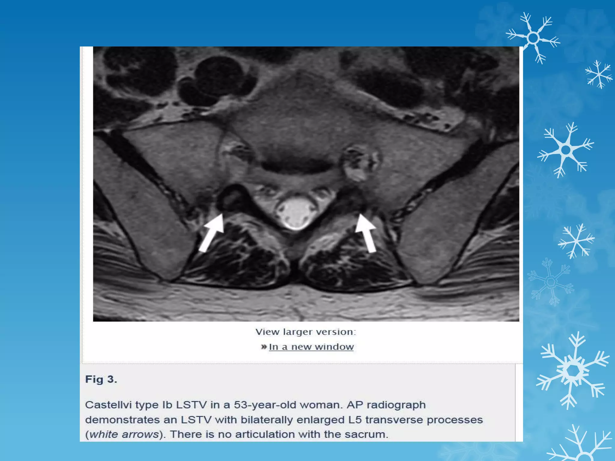 Transitional vertebrae radiology | PPTX