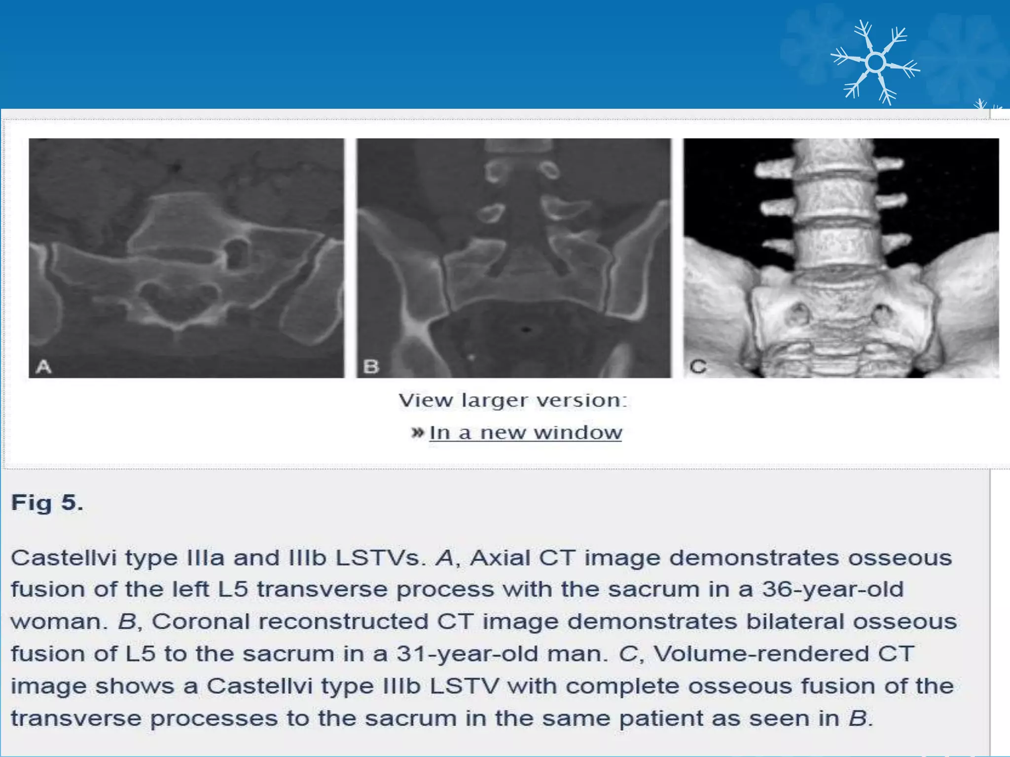 Transitional vertebrae radiology | PPTX