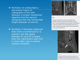 Transitional vertebrae radiology | PPTX