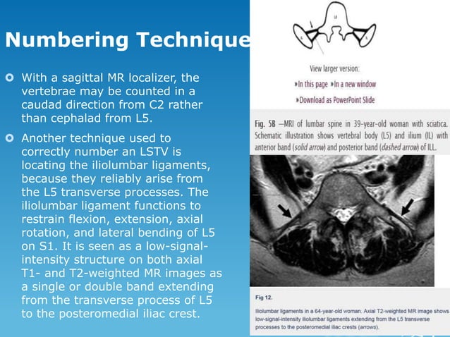 Transitional vertebrae radiology | PPTX