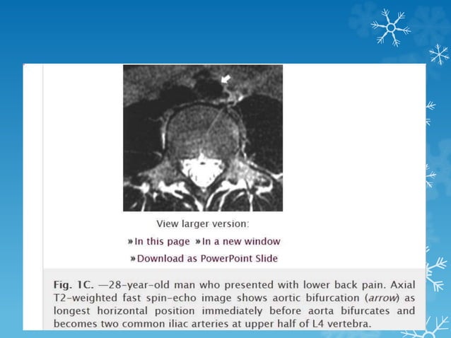 Transitional vertebrae radiology | PPTX