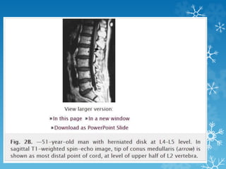 Transitional vertebrae radiology | PPTX