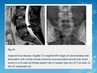 Transitional vertebrae radiology | PPTX