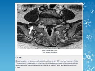 Transitional vertebrae radiology | PPTX