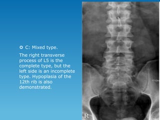 Transitional vertebrae radiology | PPTX