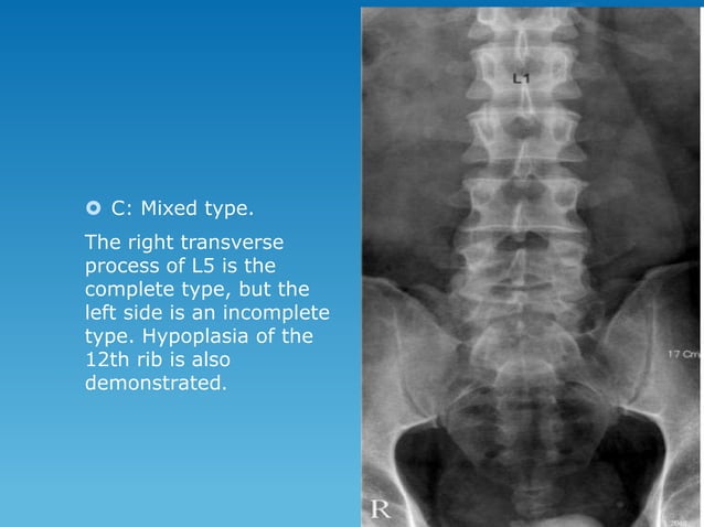 Transitional vertebrae radiology | PPTX