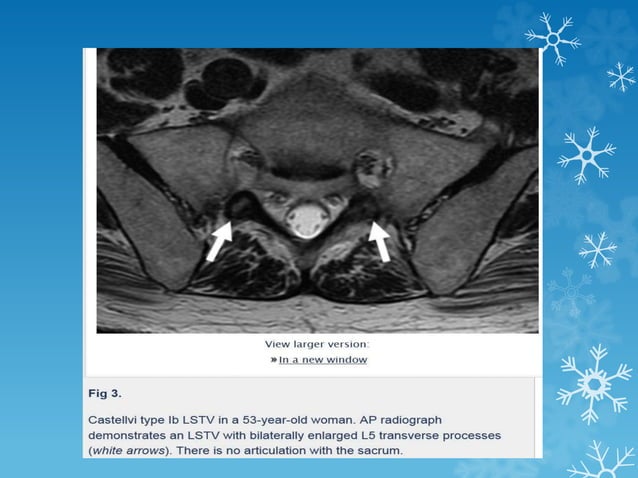 Transitional vertebrae radiology | PPTX