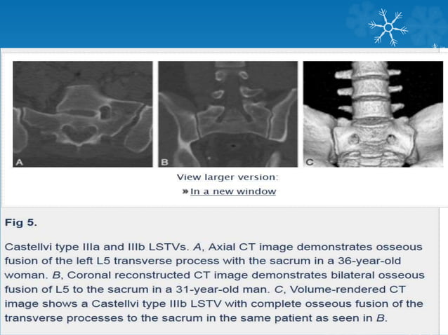 Transitional vertebrae radiology | PPTX