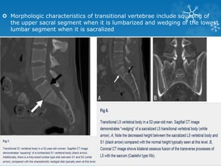 Transitional vertebrae radiology | PPTX