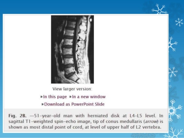 Transitional vertebrae radiology