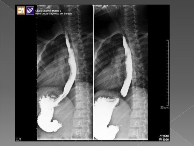 Rayos Transito esofagogastroduodenal