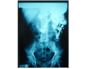 Transito intestinal | PPTX