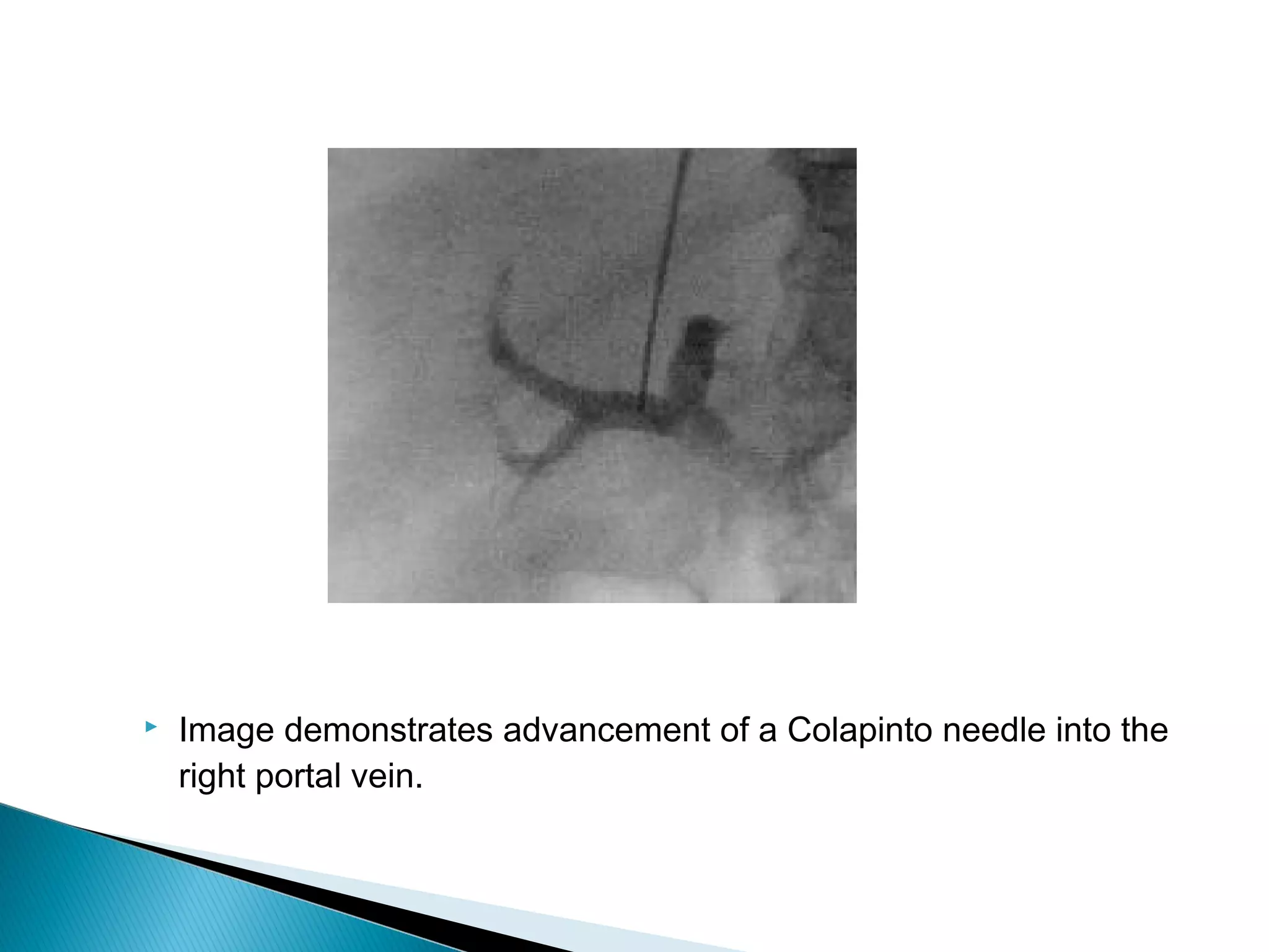 Transjugular intrahepatic porto systemic shunt | PPT
