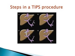 Tips Procedure