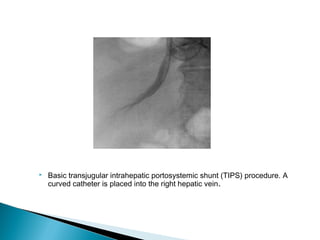 Transjugular Intrahepatic Portosystemic Shunt