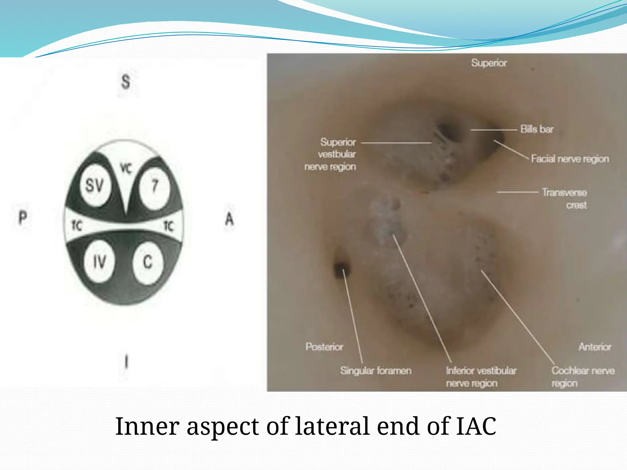 Translabyrinthine approaches for IAM.pptx