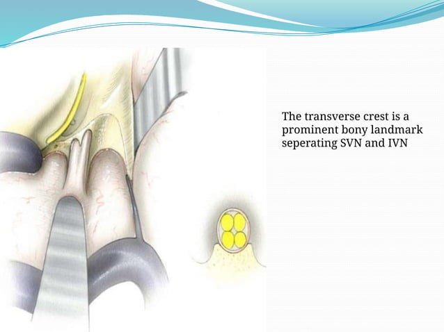 Translabyrinthine approaches for IAM.pptx