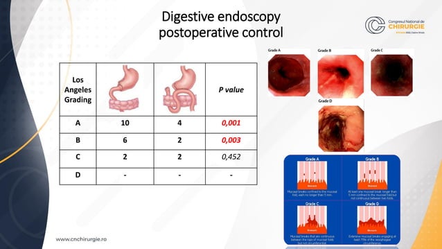 PHYSIOLOGIC VS NON-PHYSIOLOGICANASTOMOSIS AFTER SUBTOTAL GASTRECTOMIES ...