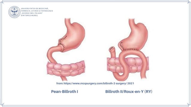 PHYSIOLOGIC VS NON-PHYSIOLOGICANASTOMOSIS AFTER SUBTOTAL GASTRECTOMIES ...