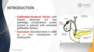 CHOLEDOCHOLITHIASIS WITH CHOLECYSTODUODENAL FISTULA AND MULTIPLE LIVER ...