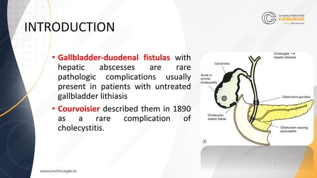 CHOLEDOCHOLITHIASIS WITH CHOLECYSTODUODENAL FISTULA AND MULTIPLE LIVER ...