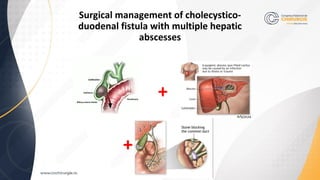 CHOLEDOCHOLITHIASIS WITH CHOLECYSTODUODENAL FISTULA AND MULTIPLE LIVER ...