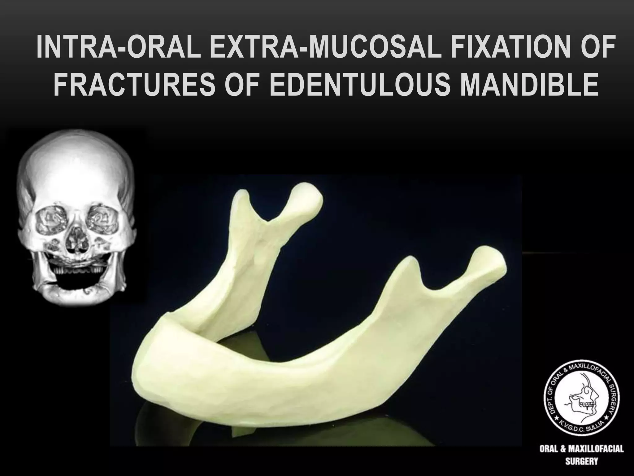 Intra-oral Extra-Mucosal Fixation of Atrophic Mandible | PPTX | Dental ...
