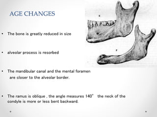 Intra-oral Extra-Mucosal Fixation of Atrophic Mandible | PPTX