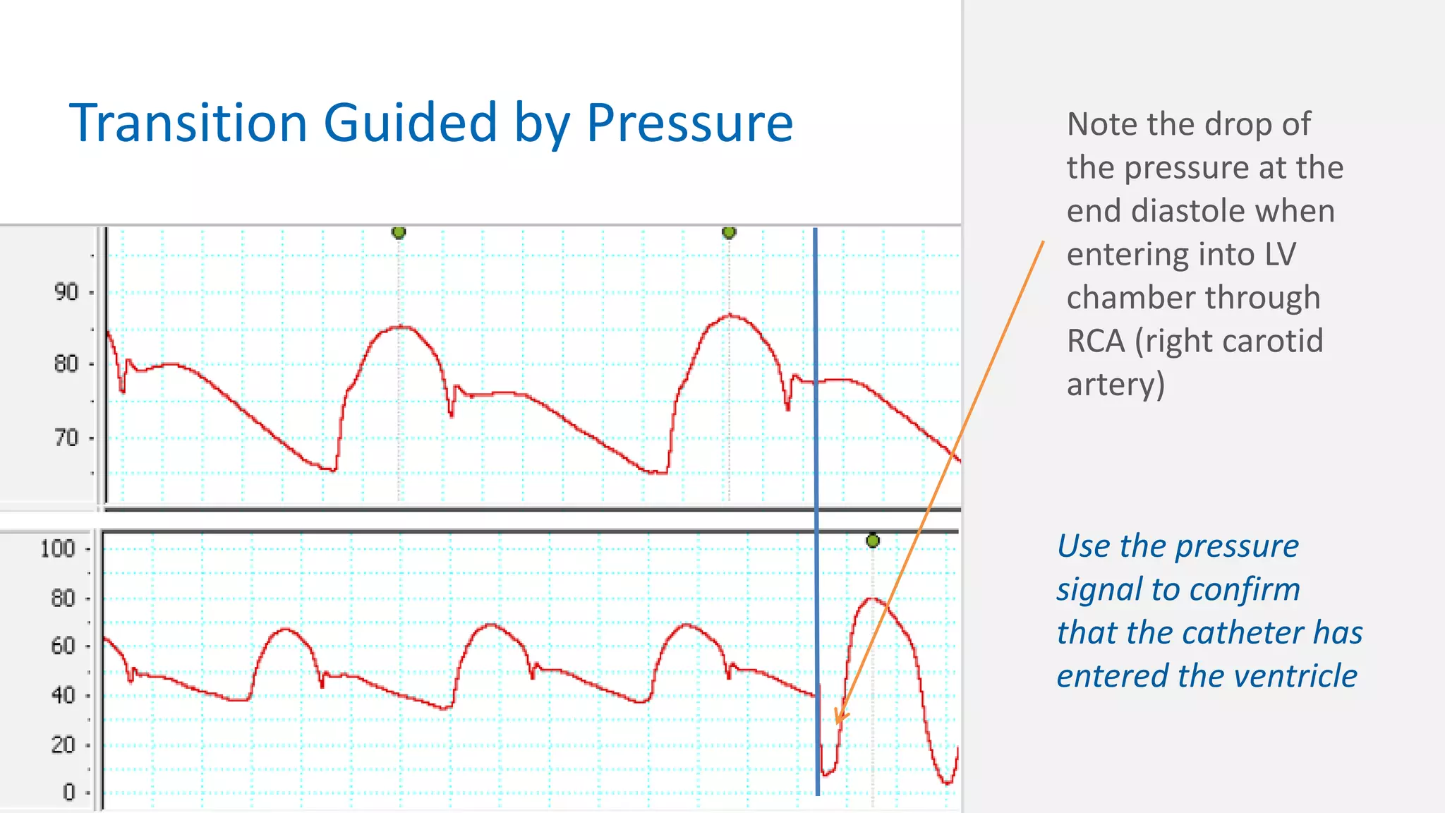 Best-Practices to Achieve Quality PV Loop Data | PDF