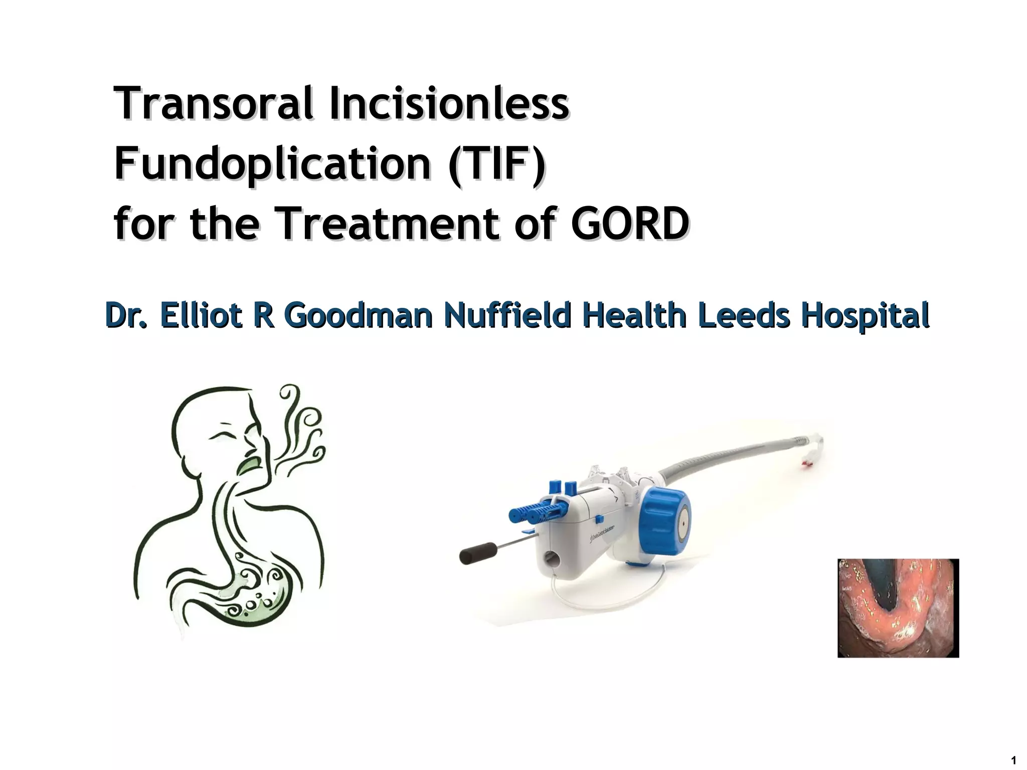 Latest presentation on endoluminal anti-reflux surgery with Esophyx | PPT