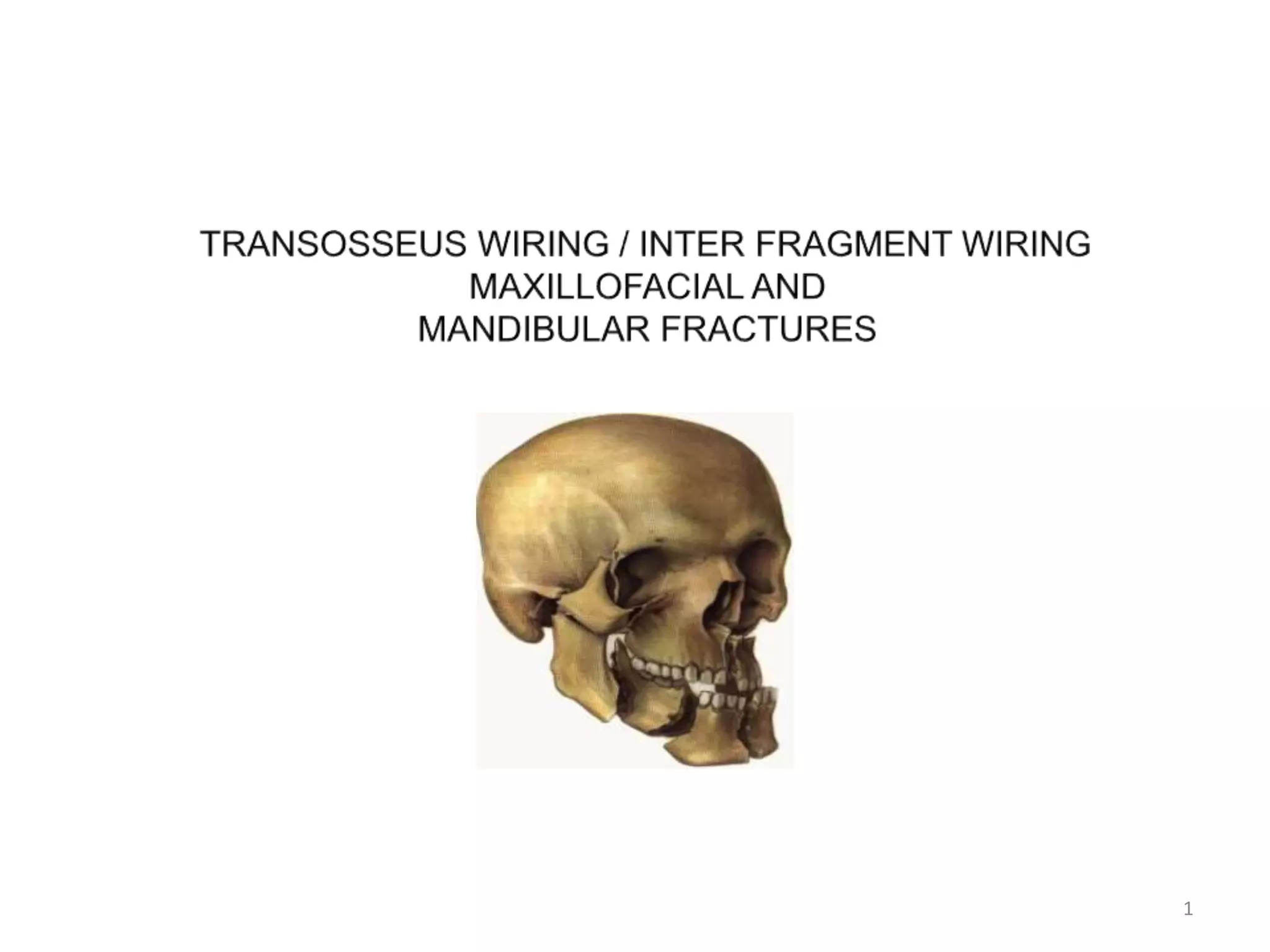 Transosseus wiring circumferential wiring dentoalveolar fracture | PPTX