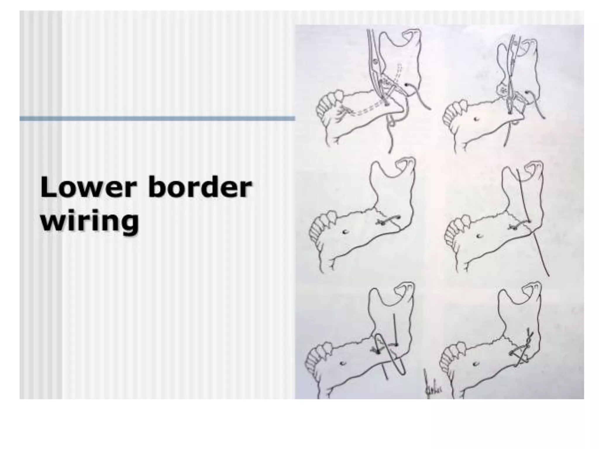 Transosseus wiring circumferential wiring dentoalveolar fracture | PPTX