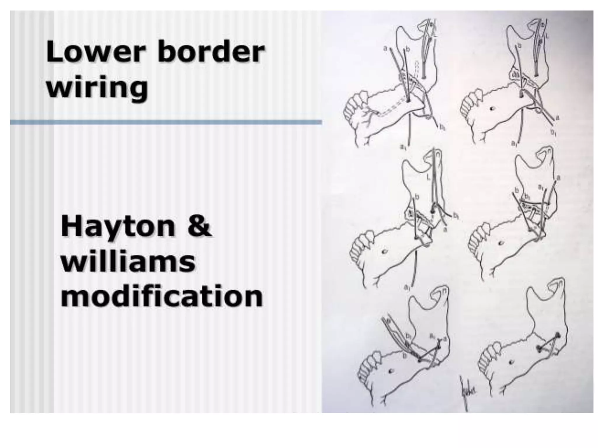 Transosseus wiring circumferential wiring dentoalveolar fracture | PPTX