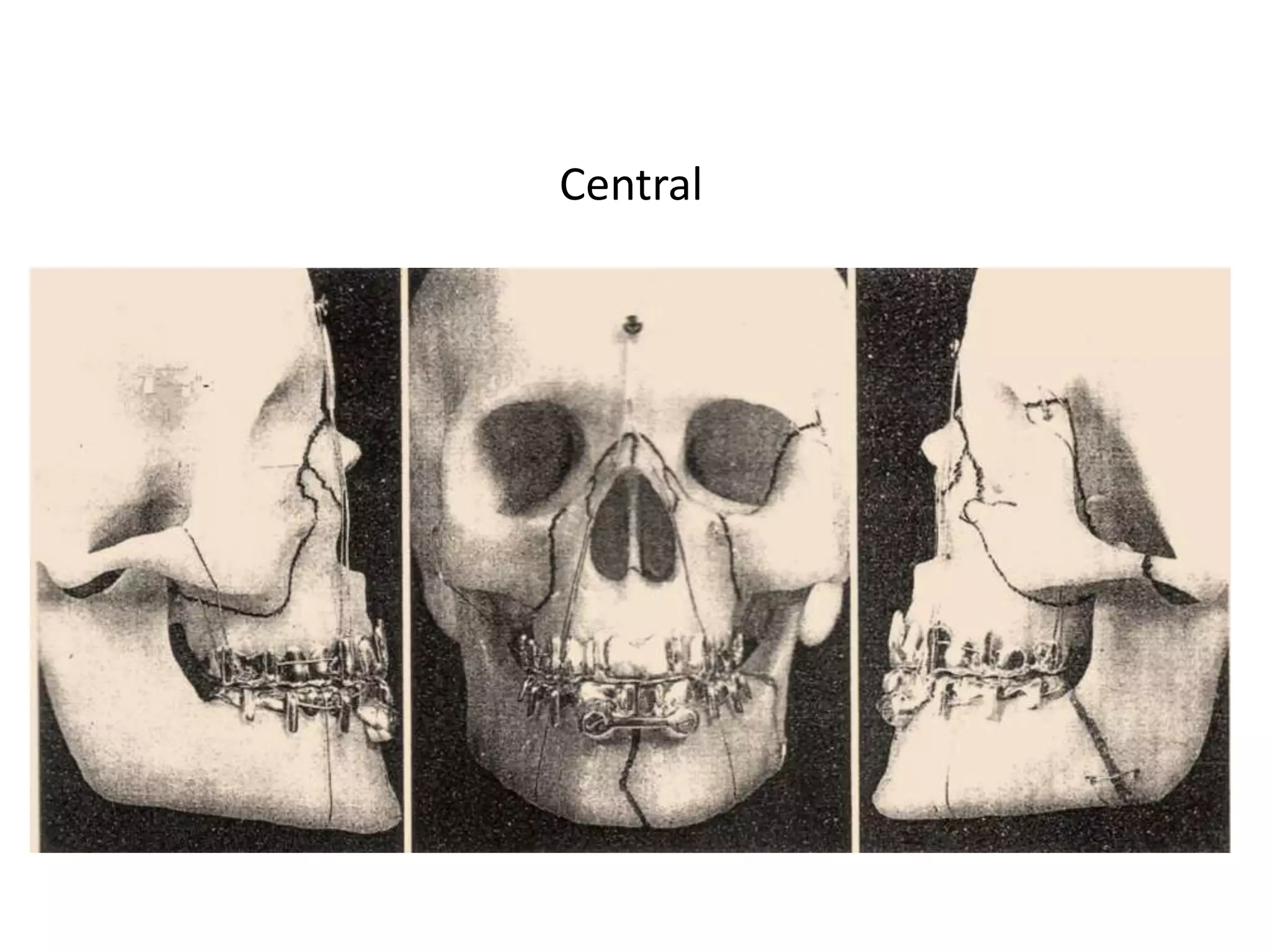 Transosseus wiring circumferential wiring dentoalveolar fracture | PPTX