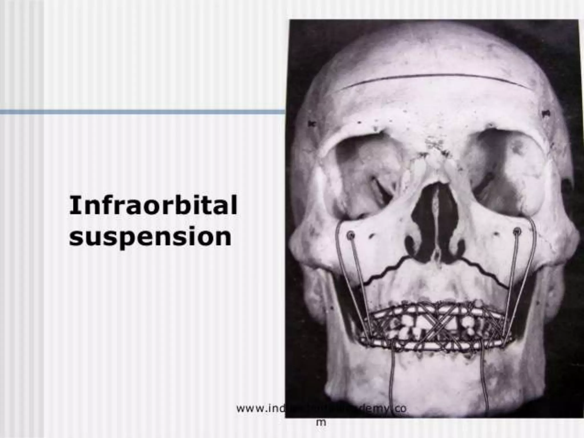 Transosseus wiring circumferential wiring dentoalveolar fracture | PPTX