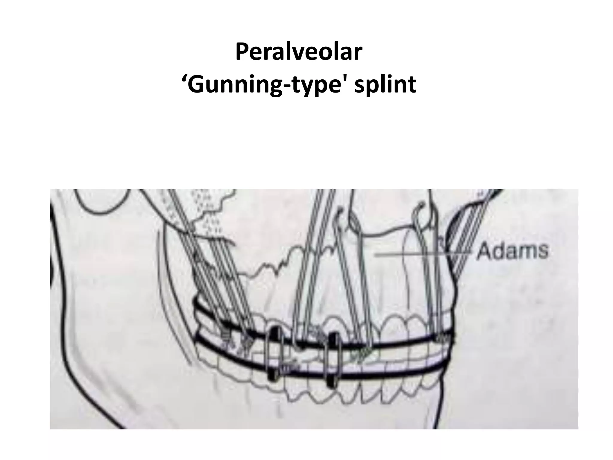 Transosseus wiring circumferential wiring dentoalveolar fracture | PPTX