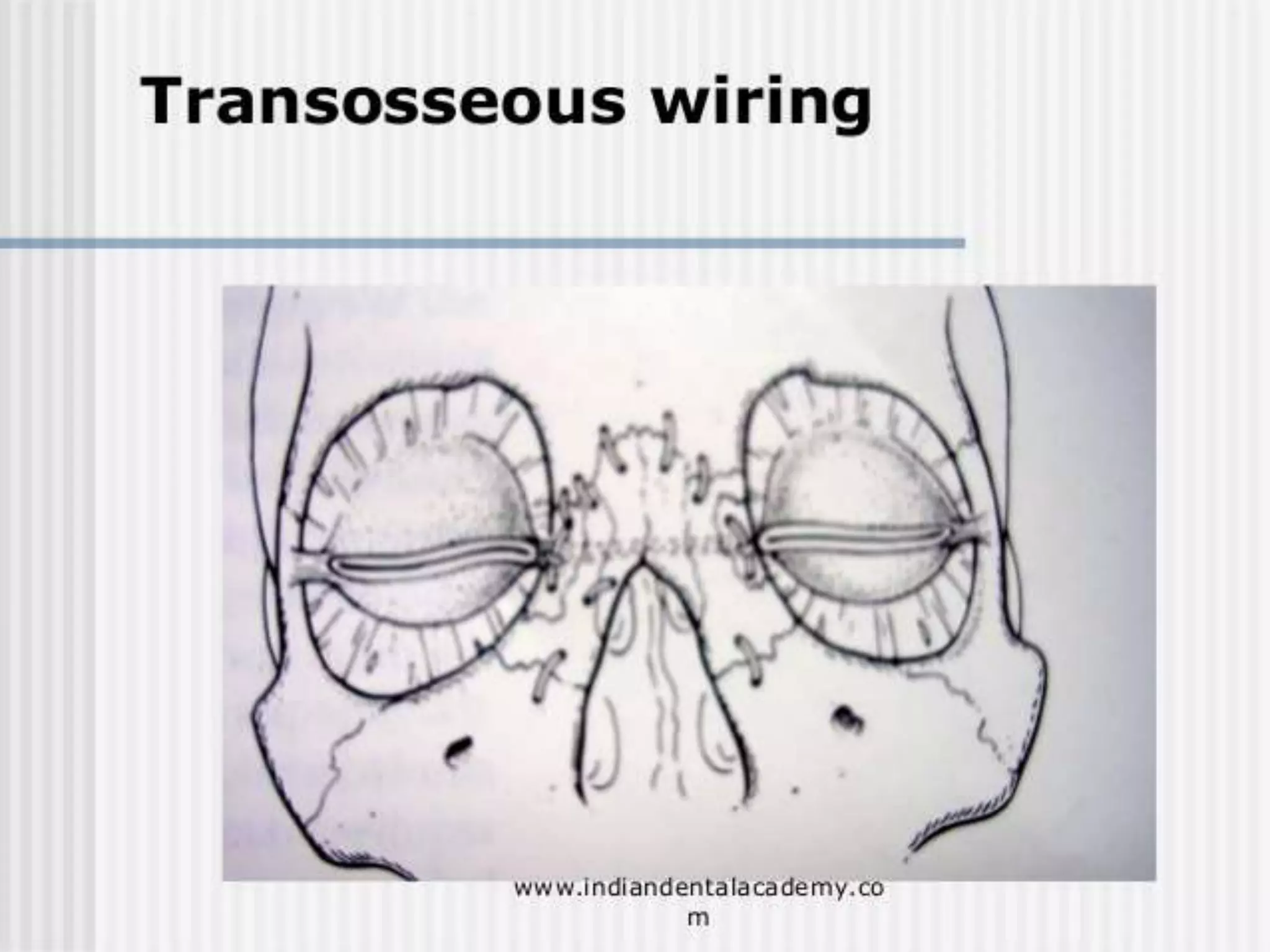 Transosseus wiring circumferential wiring dentoalveolar fracture | PPTX