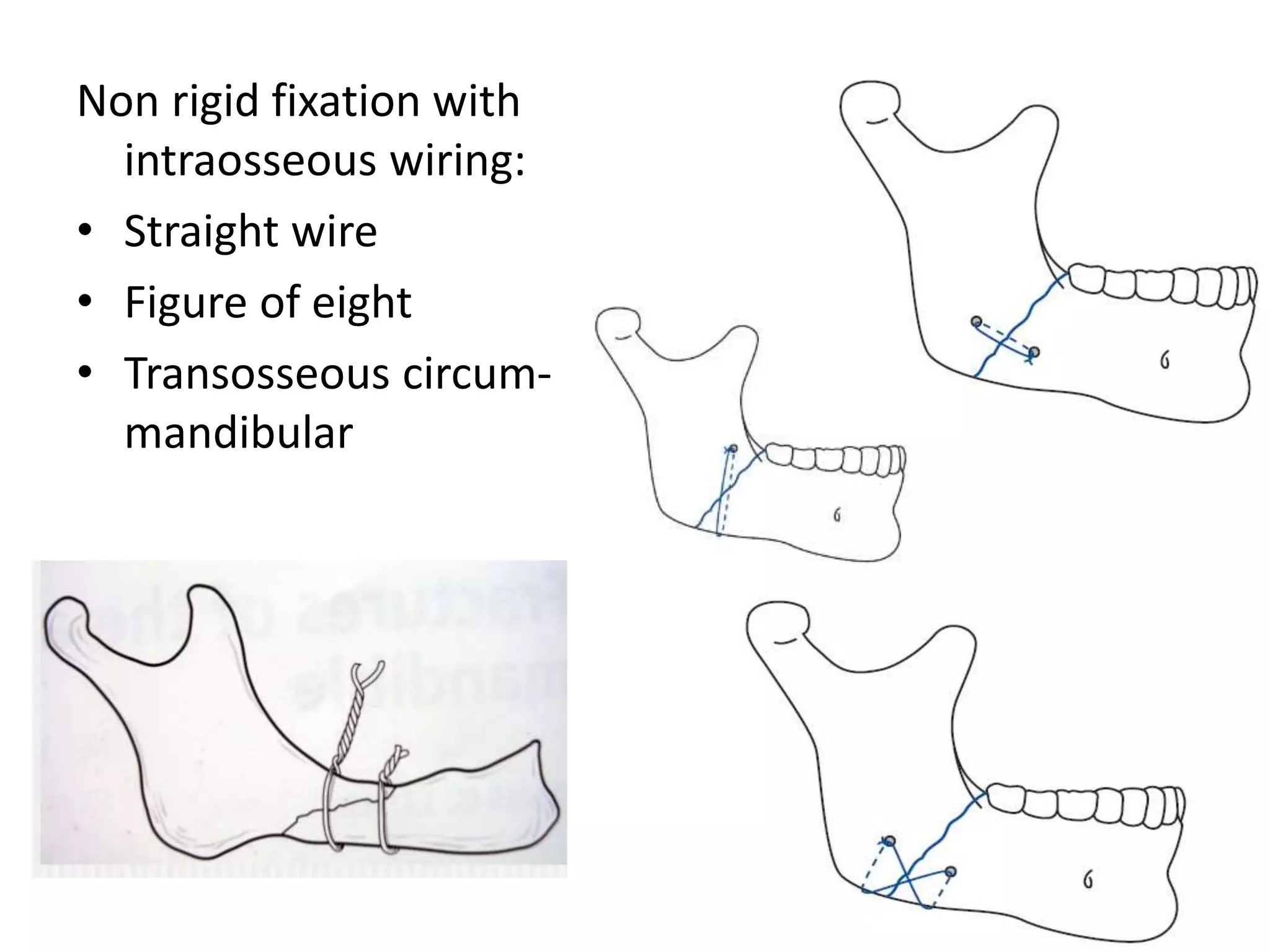 Transosseus wiring circumferential wiring dentoalveolar fracture | PPTX