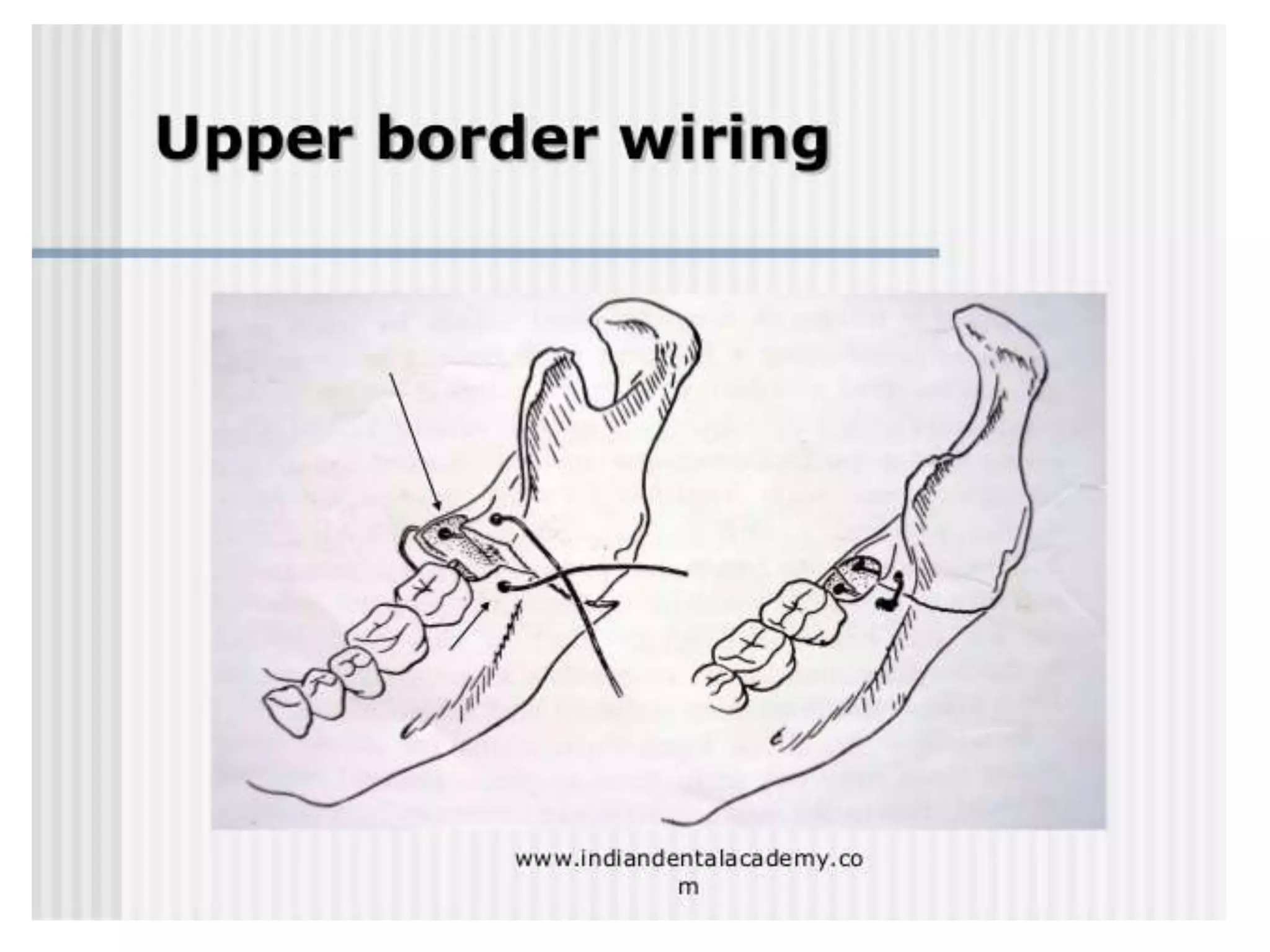 Transosseus wiring circumferential wiring dentoalveolar fracture | PPTX
