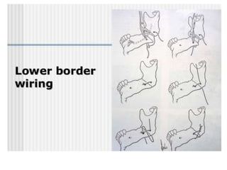 Transosseus wiring circumferential wiring dentoalveolar fracture | PPTX ...