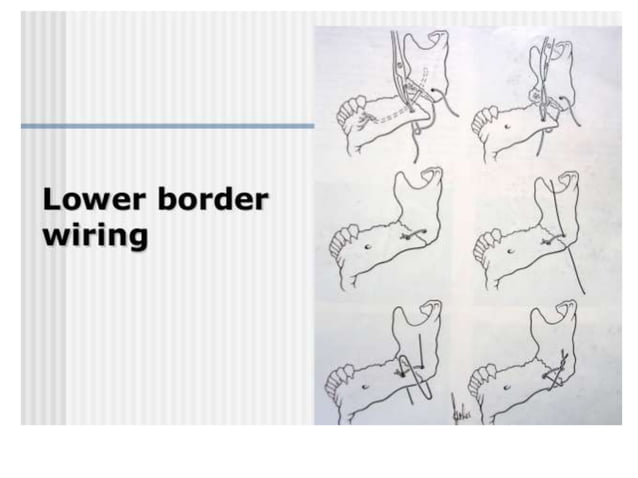 Transosseus wiring circumferential wiring dentoalveolar fracture | PPTX ...